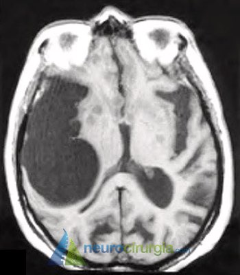 Neurocisticercose - Neurocirurgia